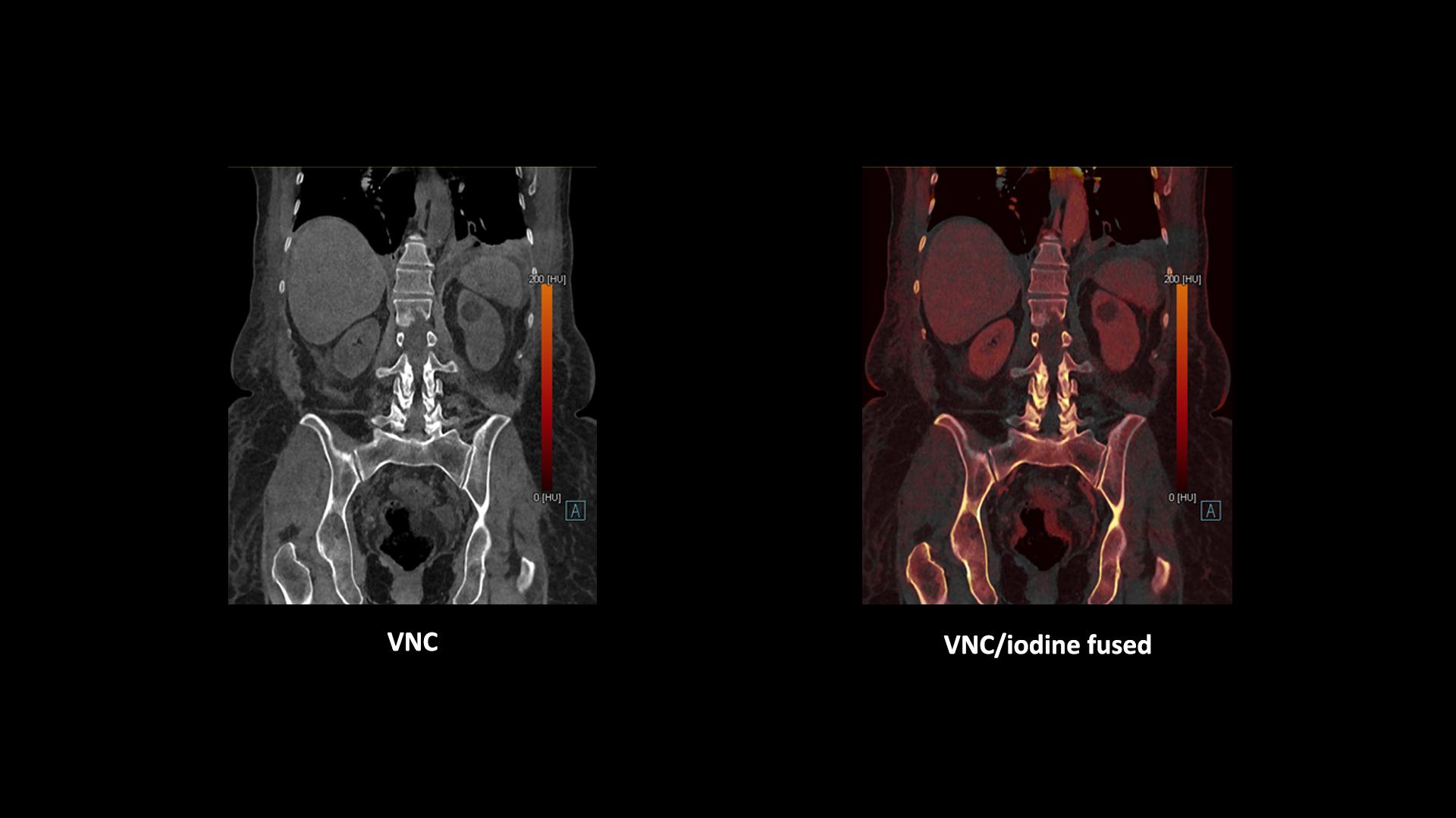 SOMATOM Definition Edge - Siemens Healthineers India