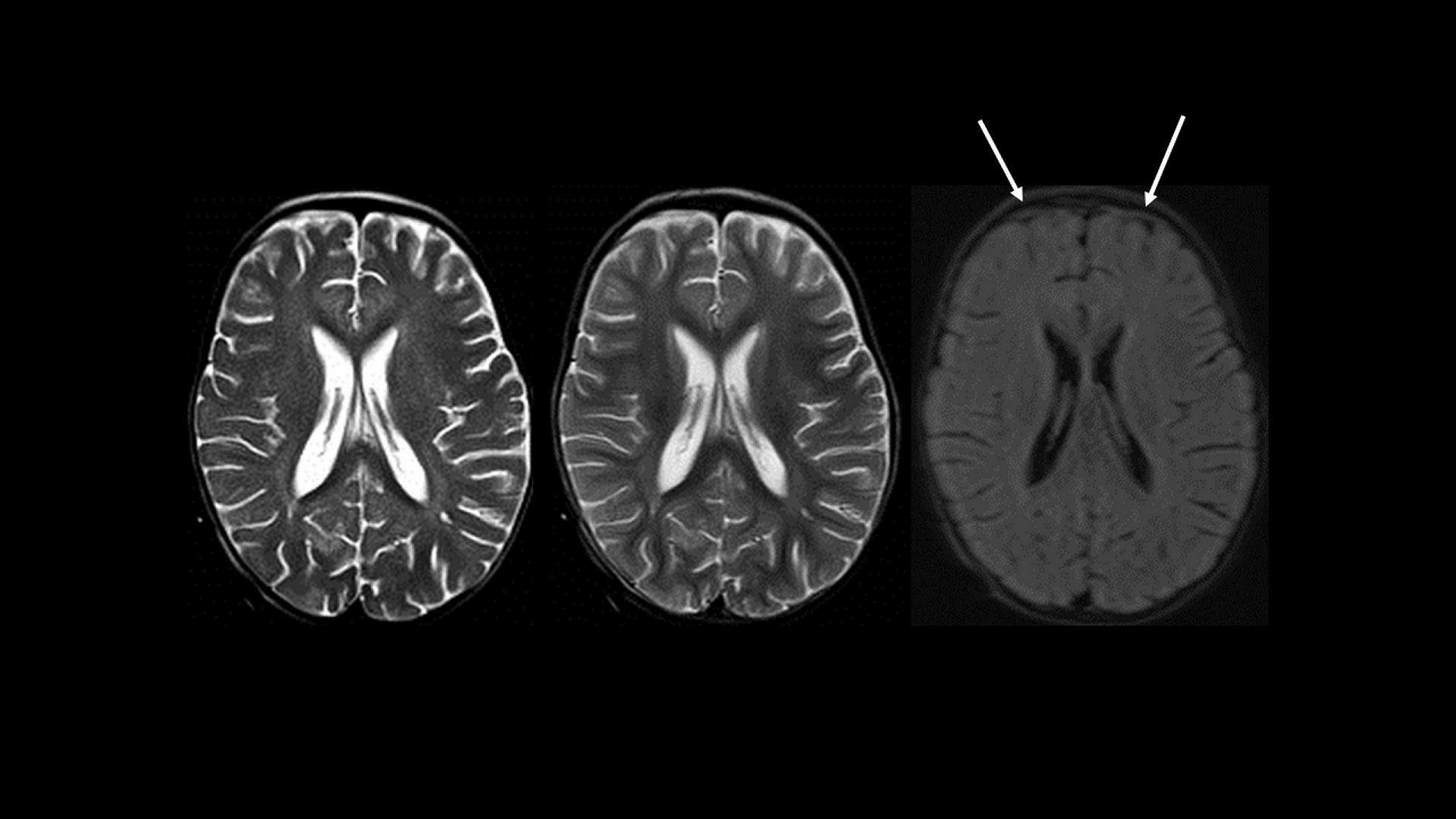 Abbreviated Turbo Spin Echo T2- and FLAIR-weighted Sequences to ...
