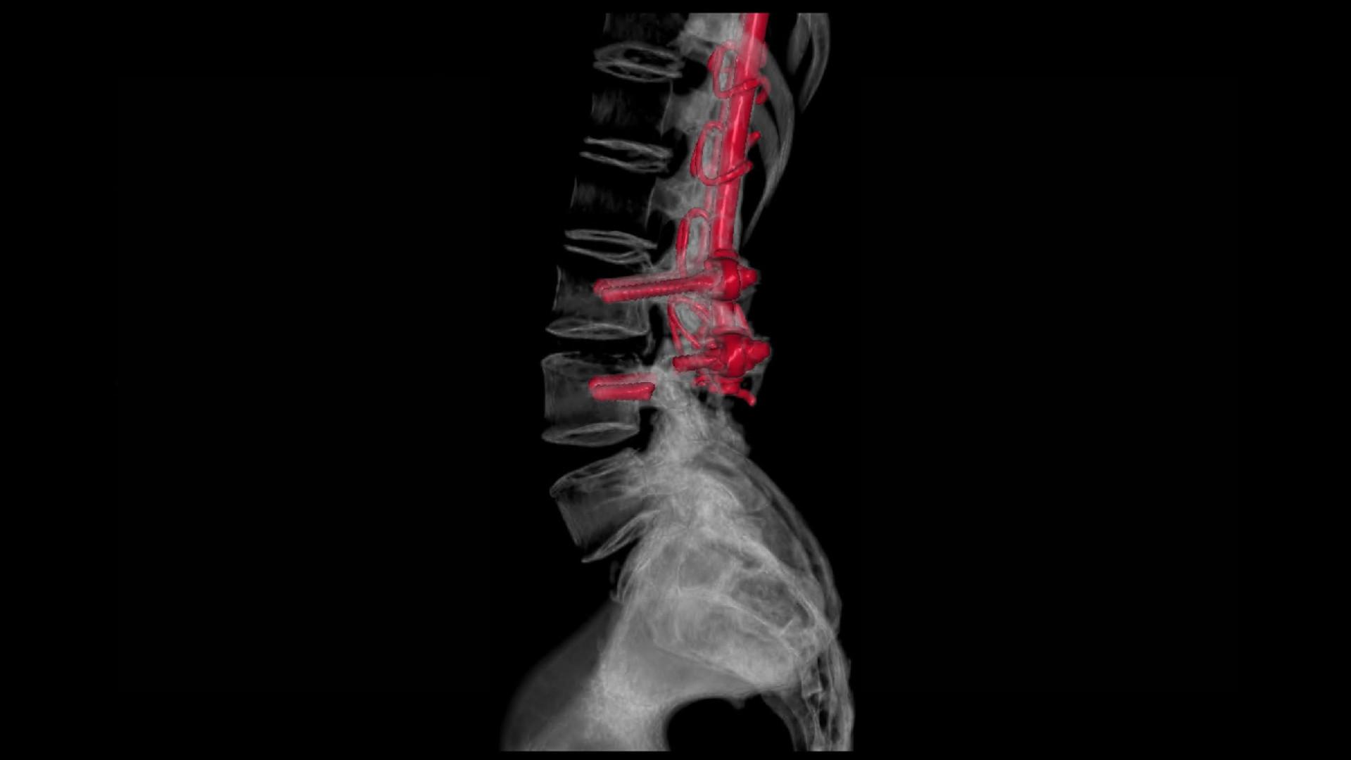 Lumbar pseudoarthrosis and screw fracture – enhanced evaluation using ...