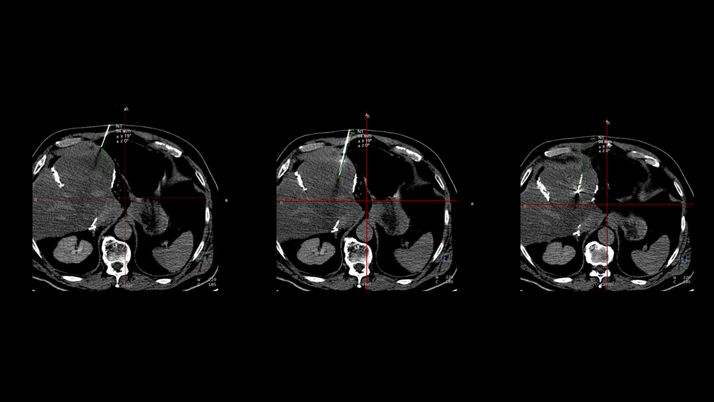 CT-guided interventional procedures on SOMATOM go.platform - Siemens ...