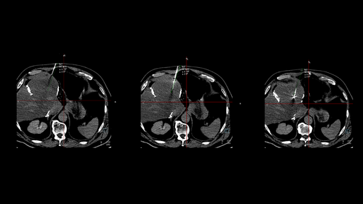 CT-guided interventional procedures on SOMATOM go. platform