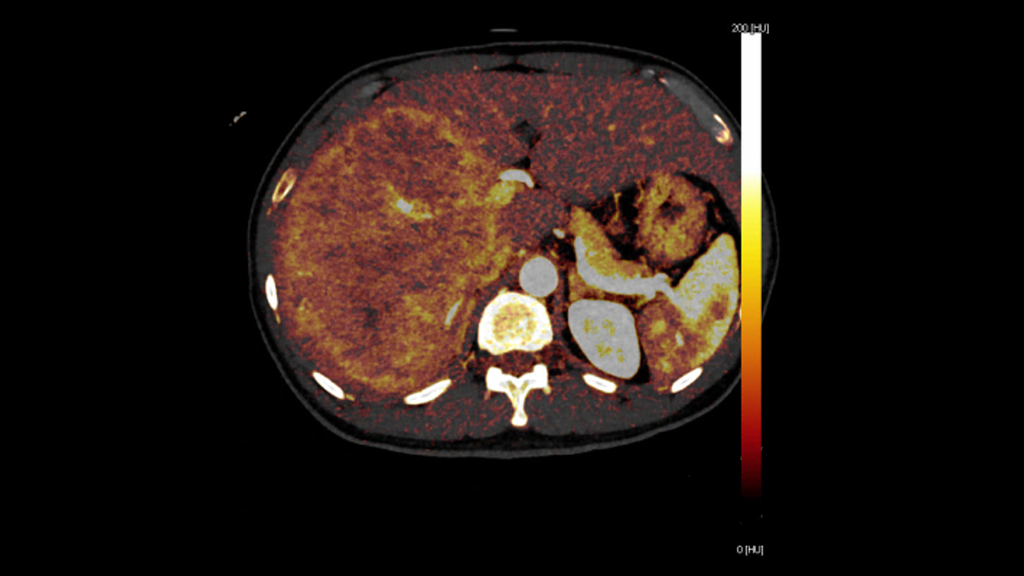 The difference between images and answers with Dual Energy CT - Siemens ...