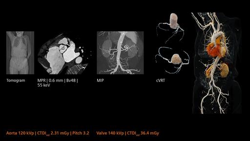 Tomografia komputerowa układu krążenia - Siemens Healthineers Polska
