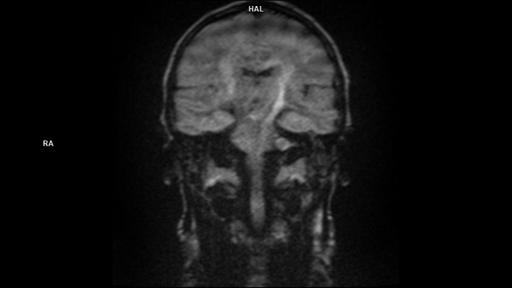T2 HASTE Diff COR-MAGNETOM Sola - Siemens Healthineers USA