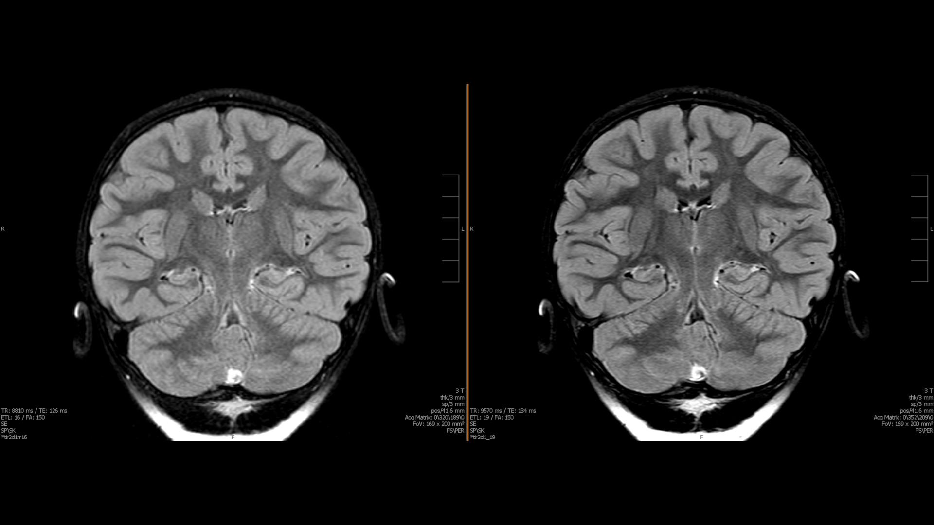 Pediatric protocols using Deep Resolve