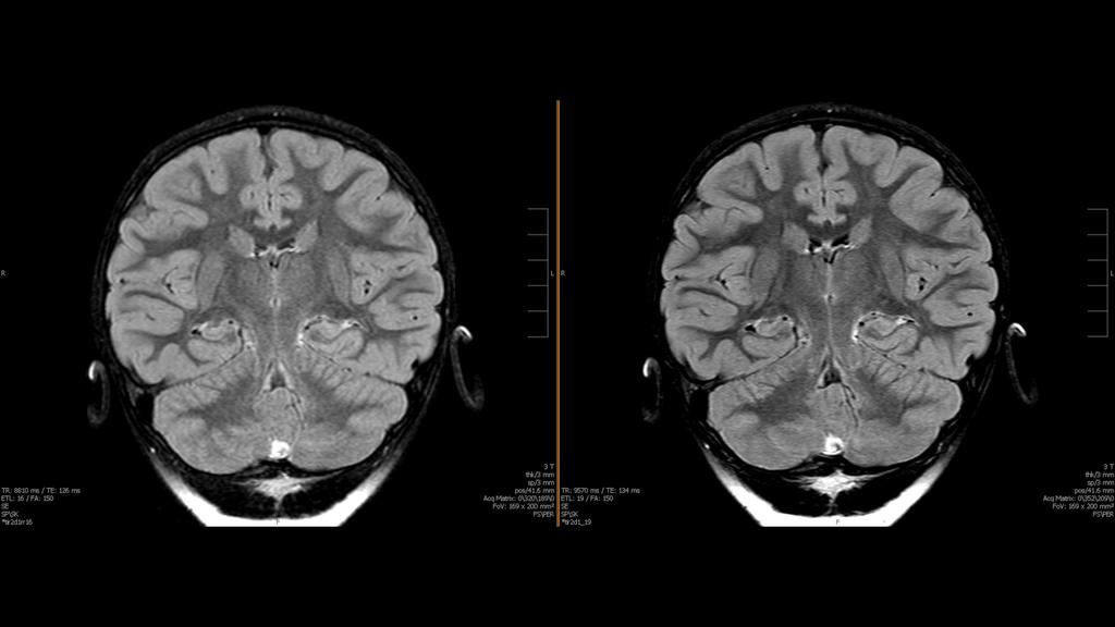 Pediatric protocols using Deep Resolve