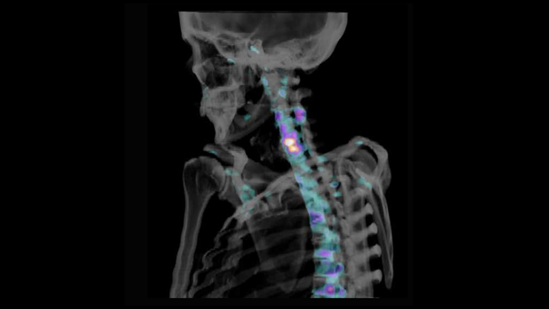 SPECT/CT in musculoskeletal medicine - Siemens Healthineers USA