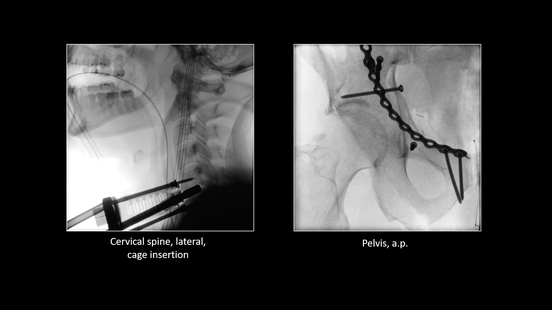 Mobile C-arm machine - Cios Select with FD - Siemens Healthineers