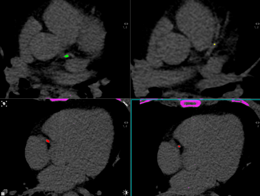 CT calcium scoring: Ultra low dose coronary Ca scoring screening ...