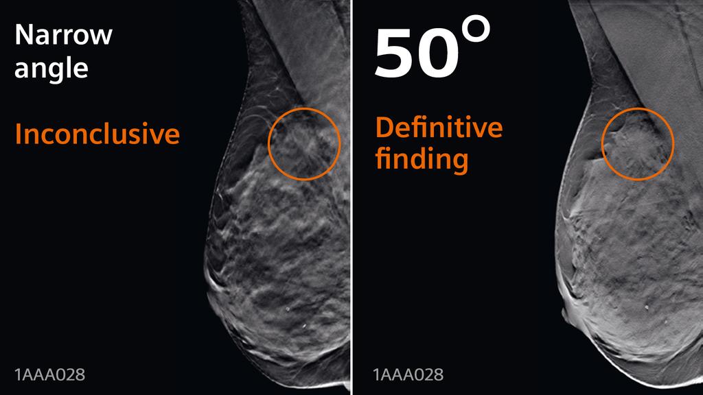 High Definition Breast Tomosynthesis – Siemens Healthineers - Siemens ...