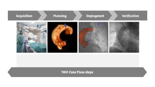 TAVI in the Hybrid OR - Siemens Healthineers