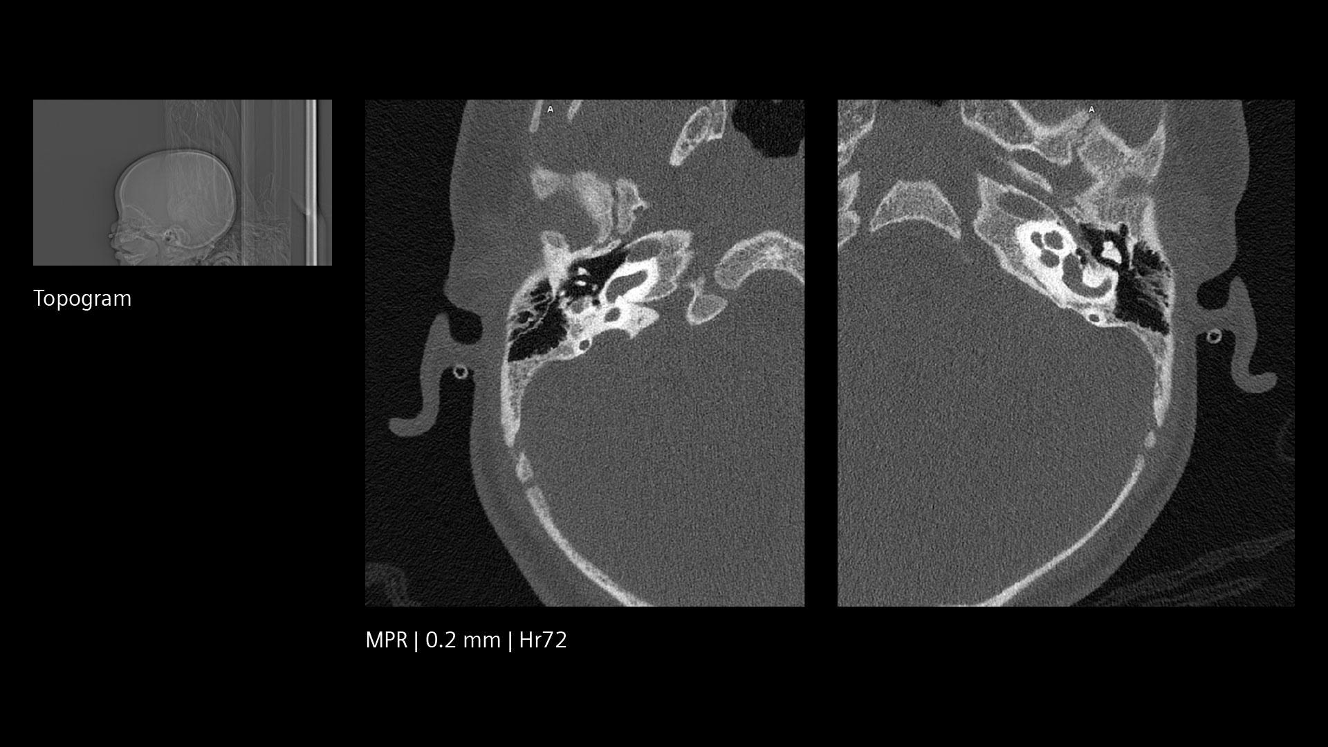 PCCT pediatric imaging - Siemens Healthineers USA