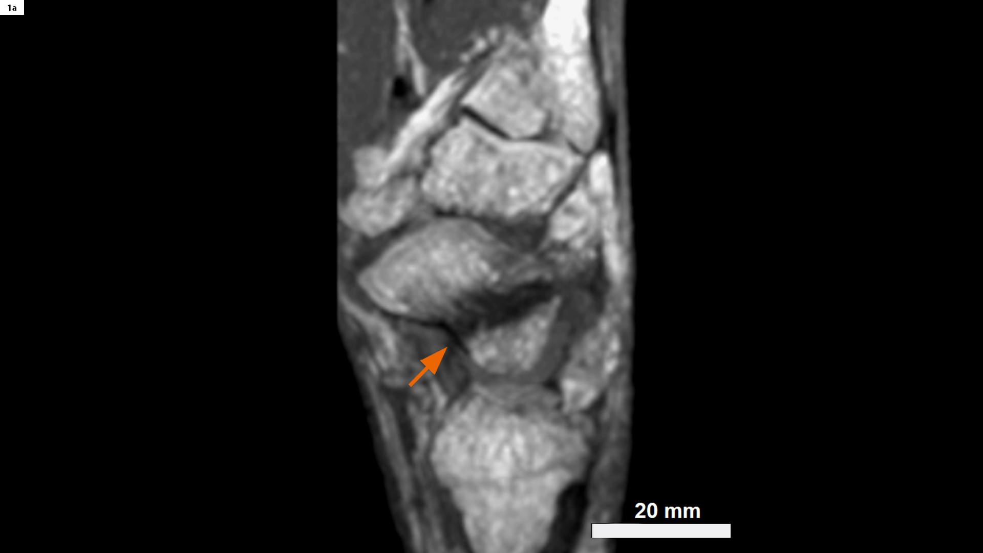 Scaphoid fracture associated bone marrow edema