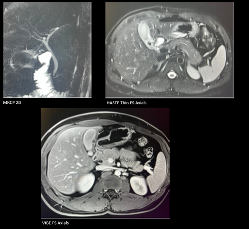 MRI Cholangio Pancreatography