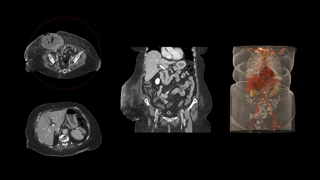 SOMATOM Edge Plus - Siemens Healthineers USA