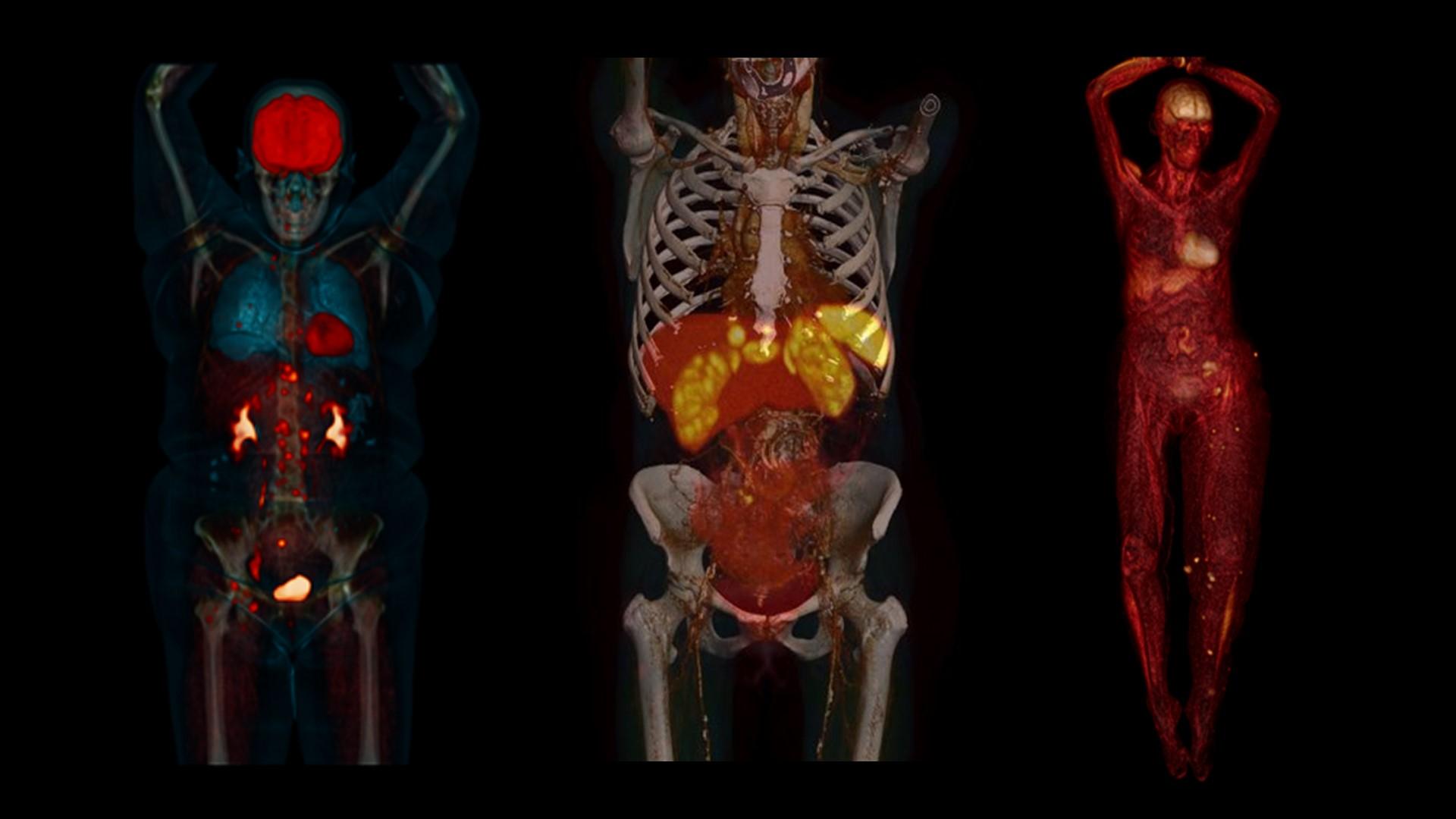 Biograph Vision Quadra News & Stories - Siemens Healthineers