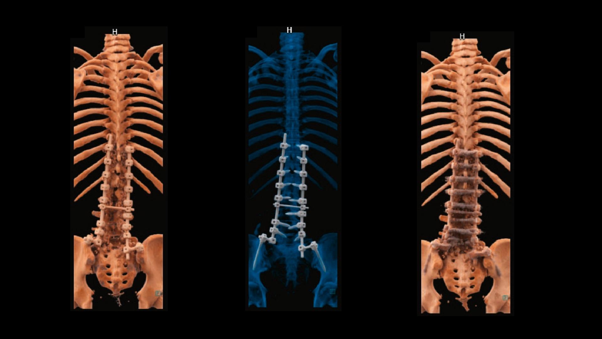Spinal osteosynthesis complicated by postoperative osteolysis and ...
