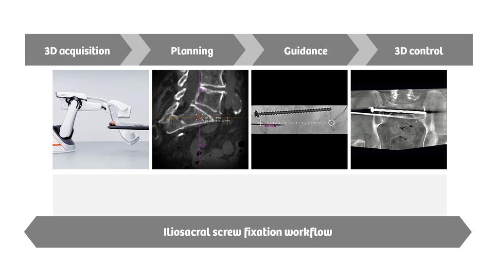 Iliosacral screw fixation in the Hybrid OR - Siemens Healthineers