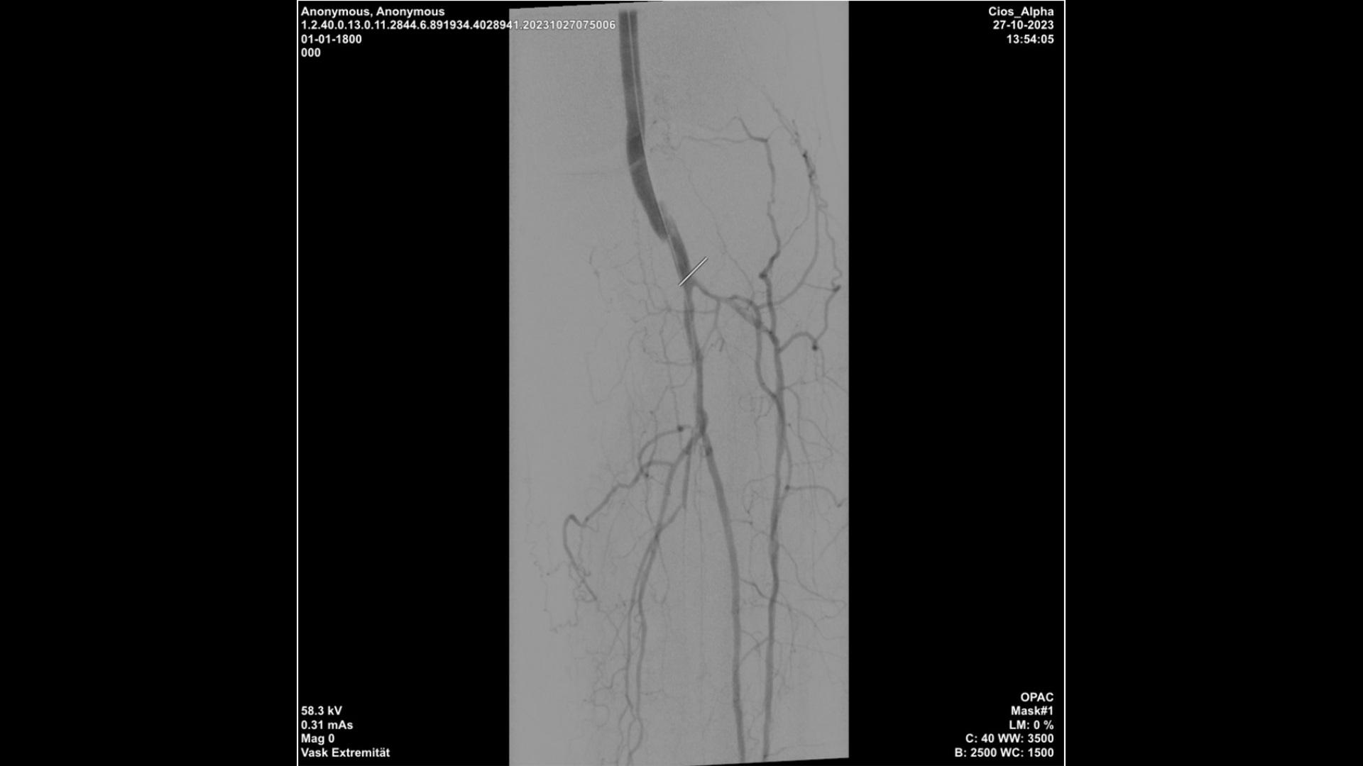 Cios Alpha.neo – Mobile C-arm machine