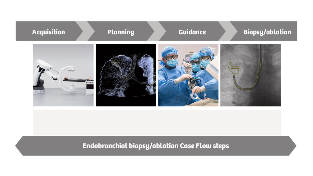 Endobronchial Interventions in the Hybrid OR - Siemens Healthineers