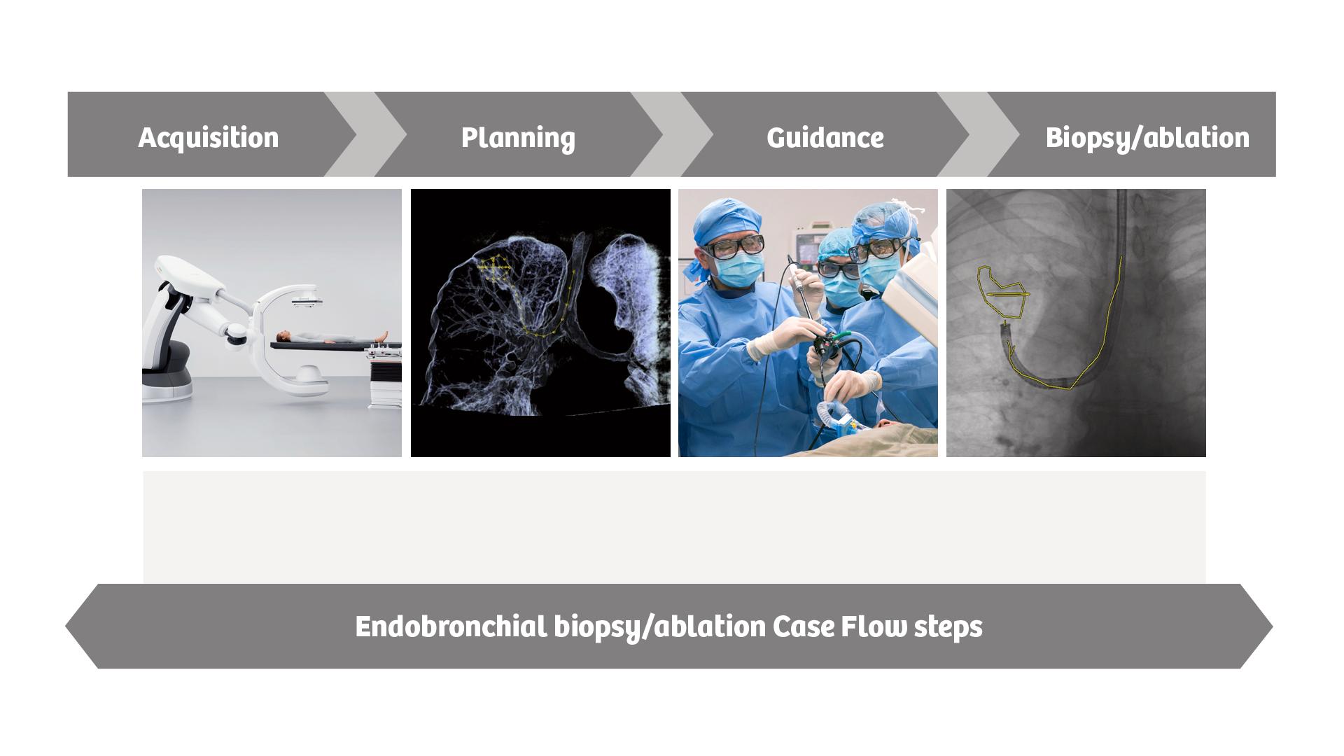 Endobronchial Interventions in the Hybrid OR - Siemens Healthineers