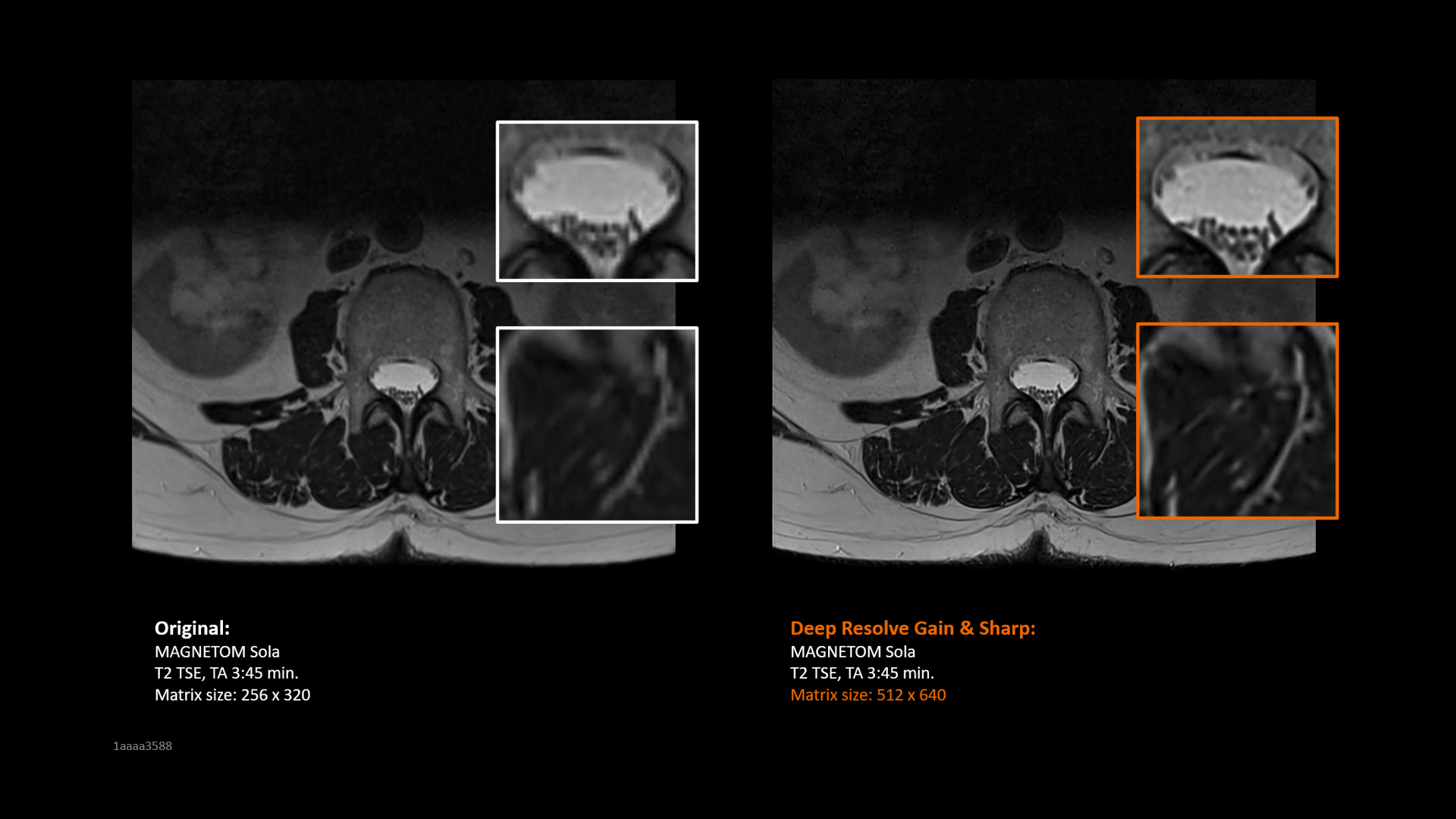 Deep Resolve Sharp - Siemens Healthineers