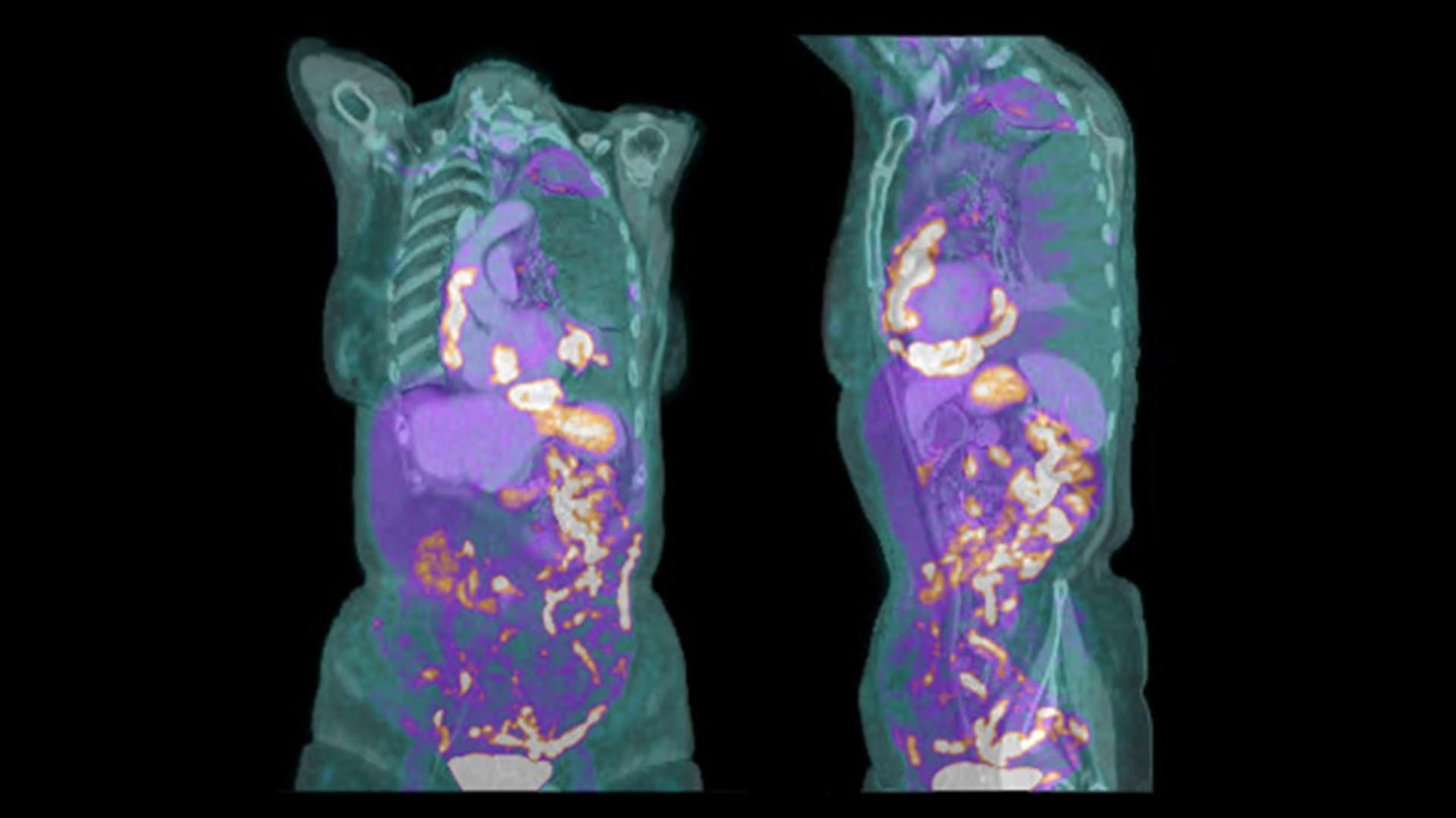 18F-FDG PETCT delineation of predominantly pericardial involvement in recurrent pleural ...