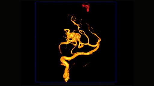 Neurosurgery - Siemens Healthineers