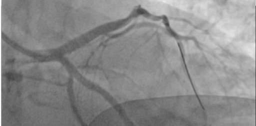 Enhanced stent visualization assists in improving the outcome of ...