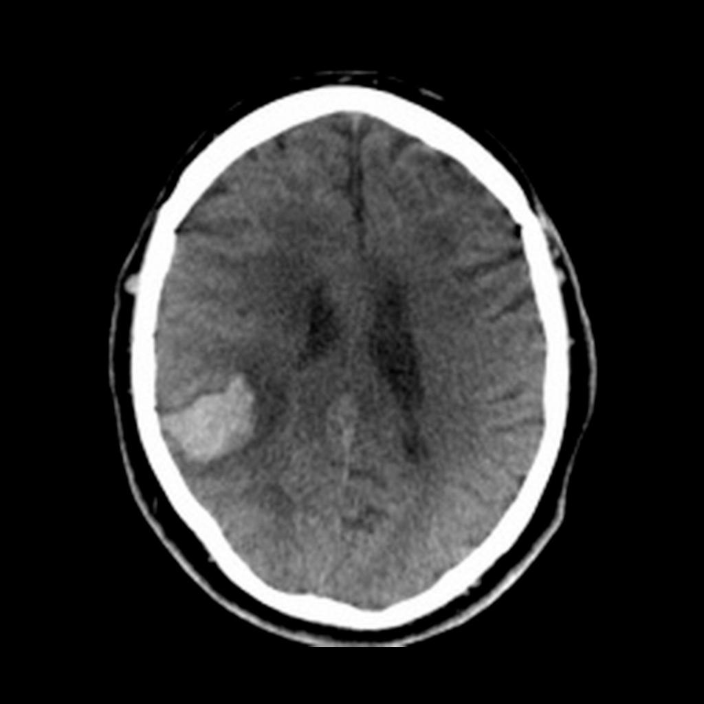 Advanced Stroke Management & Patient Care - Siemens Healthineers USA