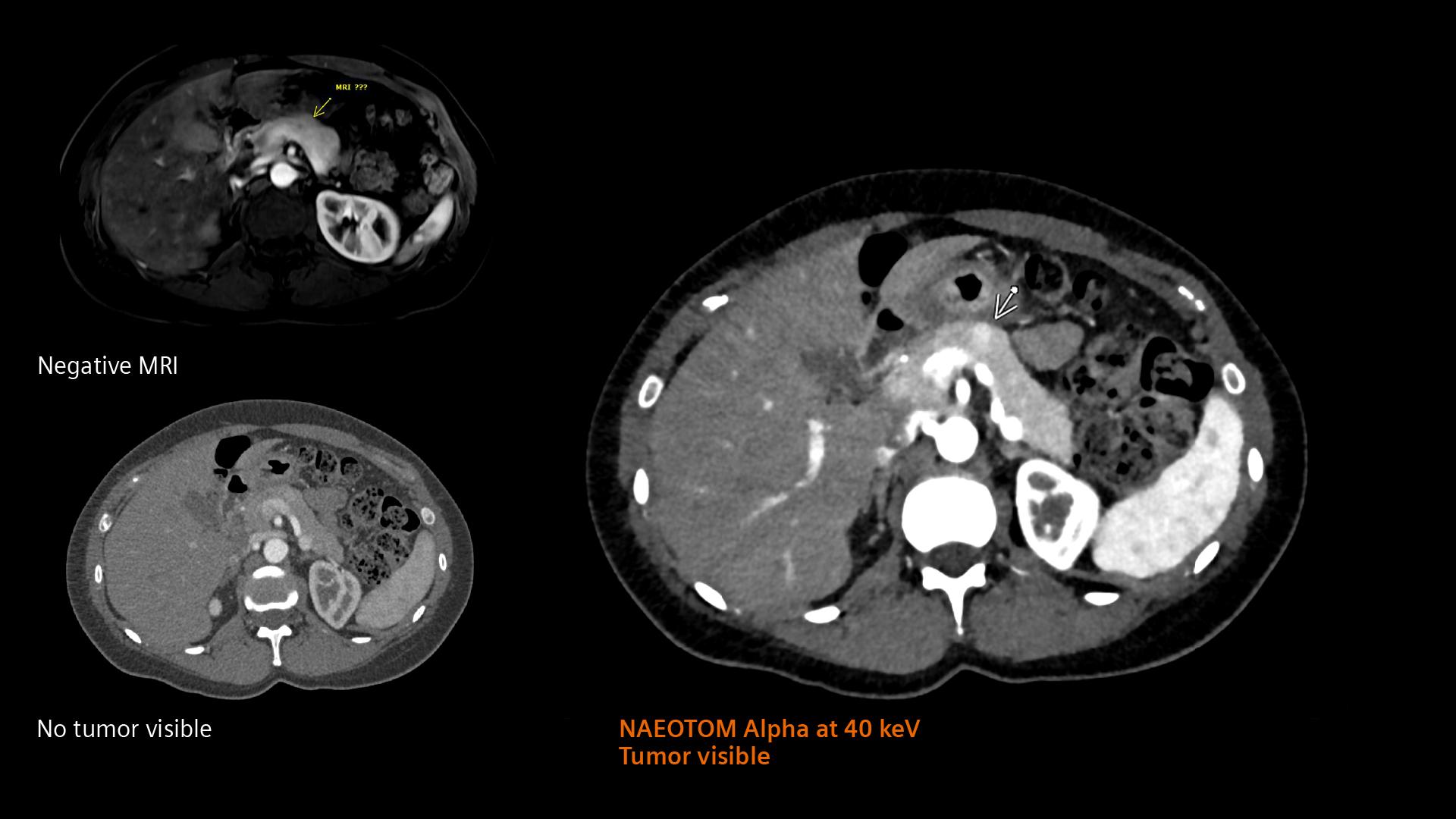 PCCT oncology imaging - Siemens Healthineers