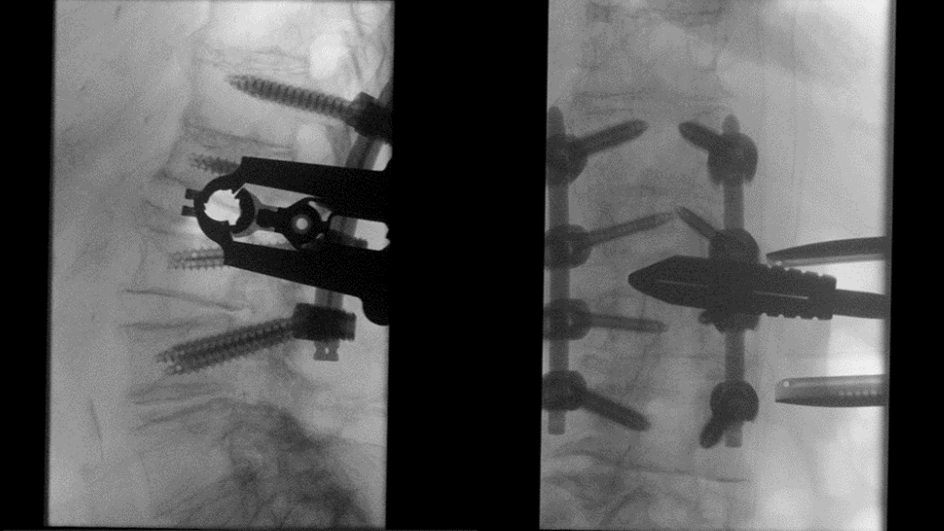 Mobile C-arm machine - CIARTIC Move - Siemens Healthineers