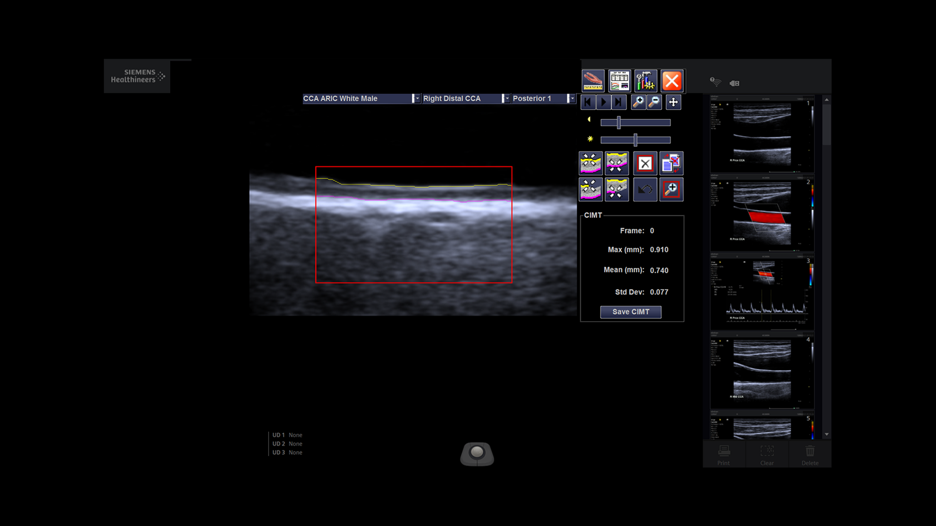 ACUSON Juniper, CV Edition Ultrasound System - Siemens Healthineers