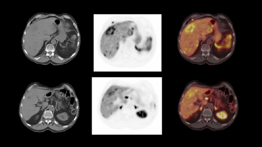 Single-bed, whole-body 68Ga DOTATATE PET/CT delineation of ...
