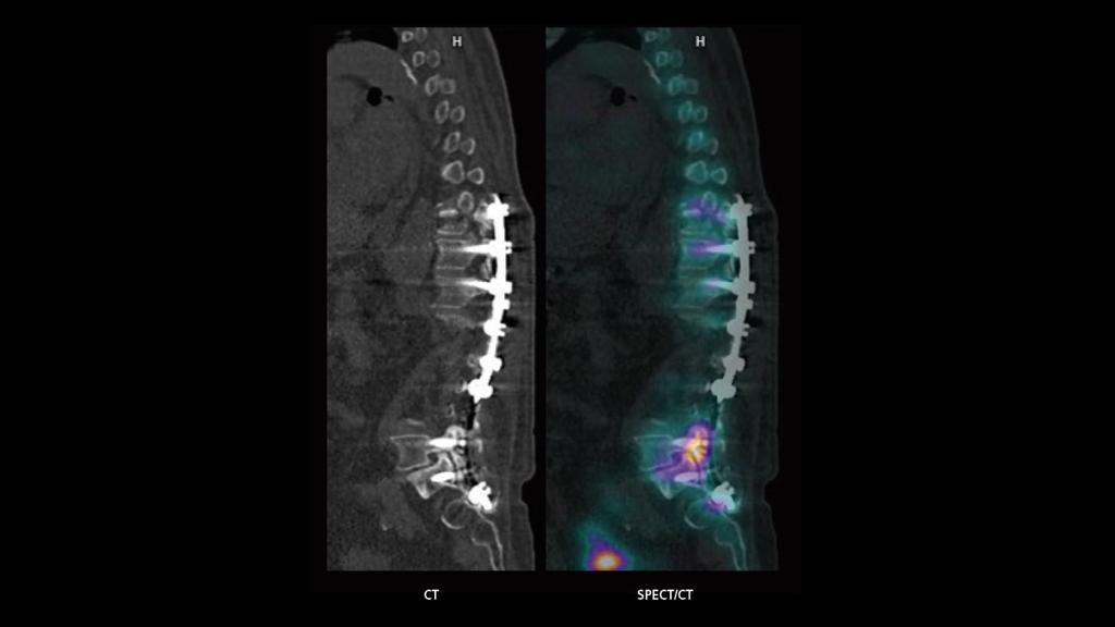 SPECT/CT imaging in the evaluation of pain following spinal fusion ...