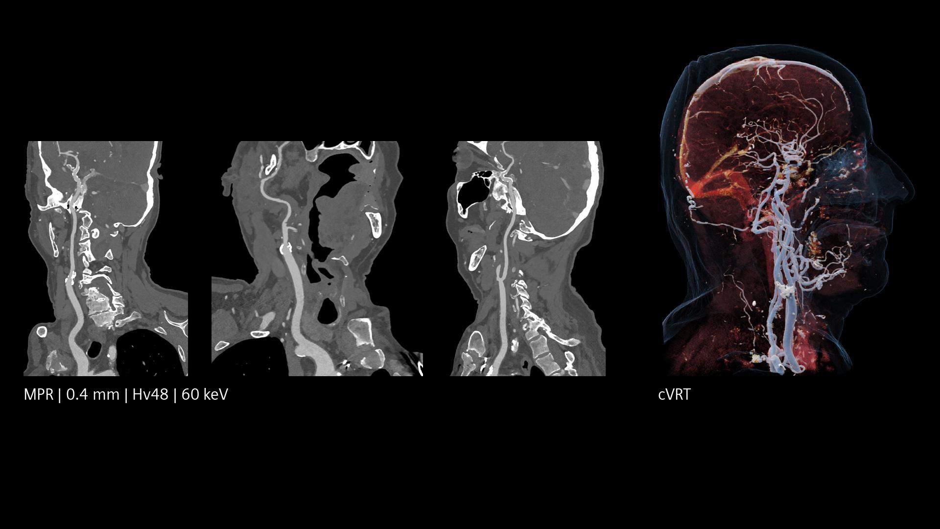 PCCT neurology imaging - Siemens Healthineers
