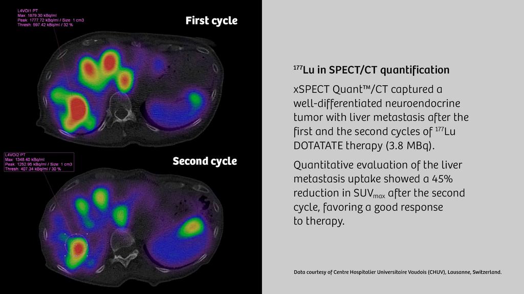 Moving SPECT/CT forward - Siemens Healthineers India