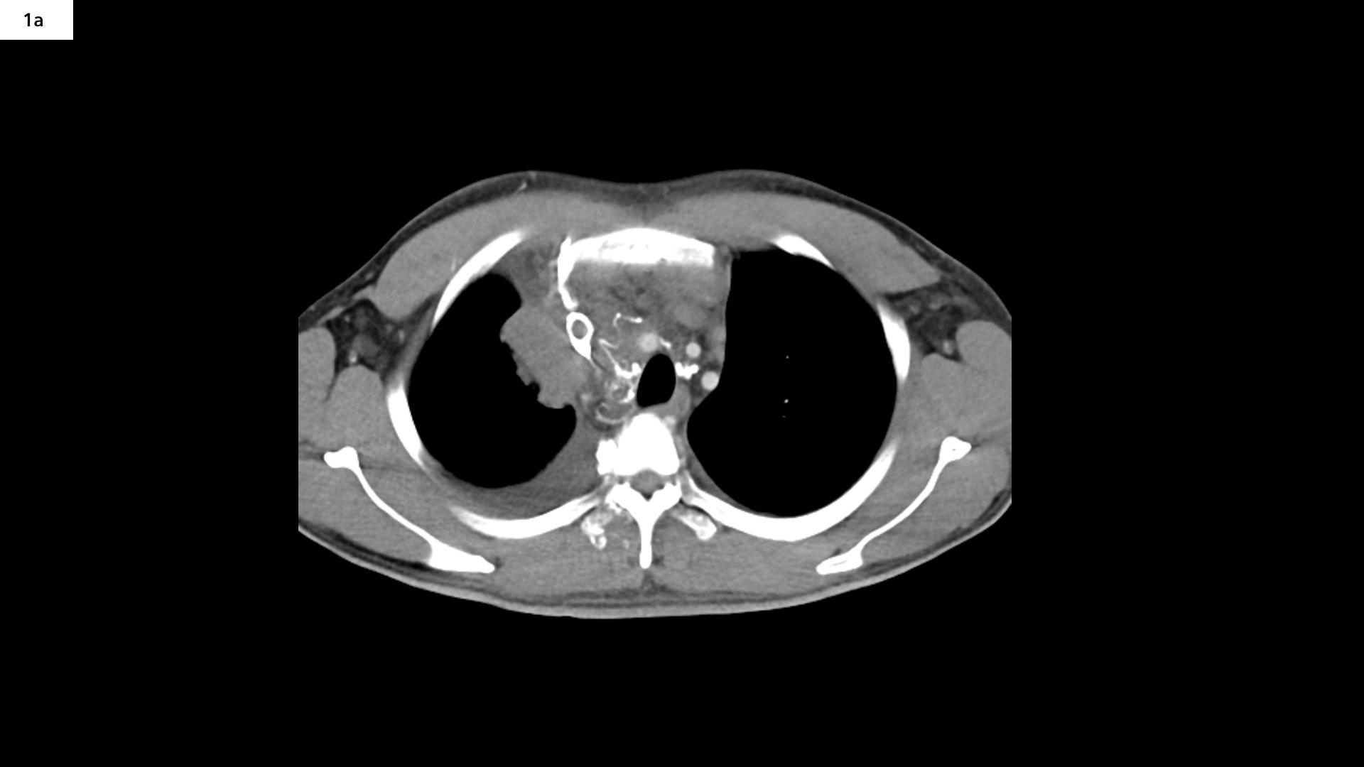 Superior vena cava obstruction caused by a primary mediastinal large B ...
