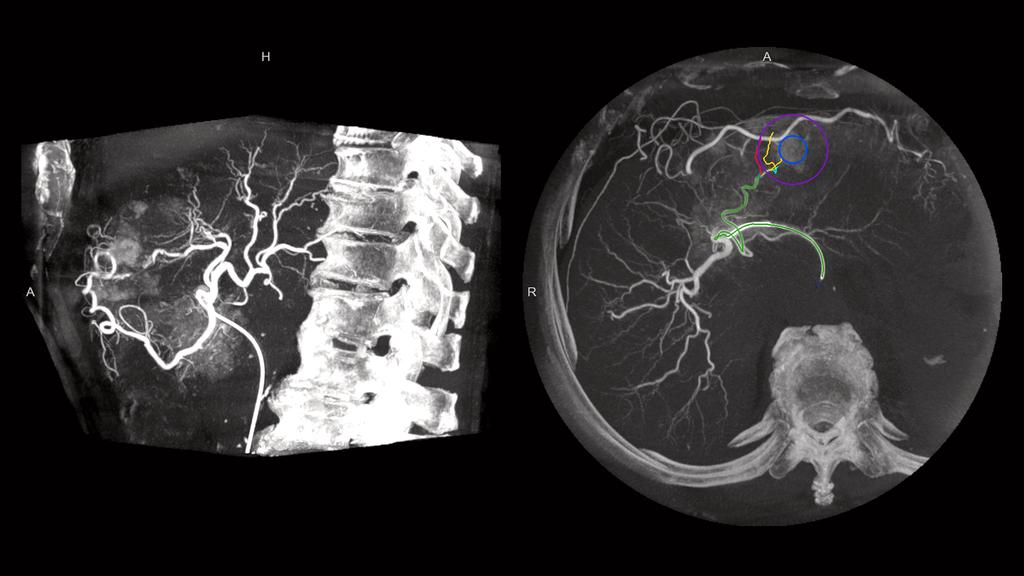 Interventional Oncology Procedures - Siemens Healthineers