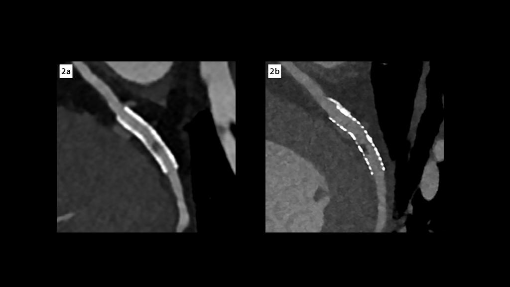 Multiple coronary stents – in-stent restenosis - Siemens Healthineers USA