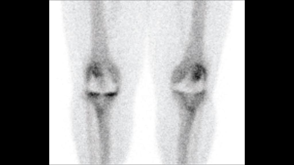 SPECT/CT Detection In TKA Prosthetic Loosening - Siemens Healthineers USA