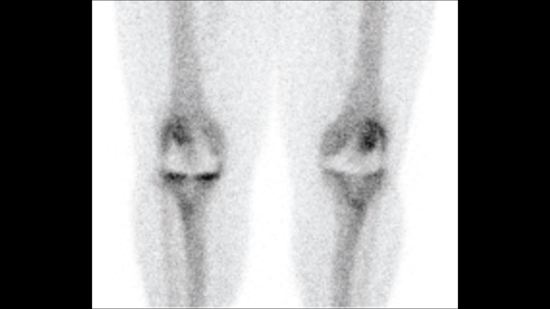 SPECT/CT Detection In TKA Prosthetic Loosening - Siemens Healthineers USA