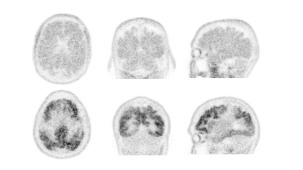 Image-Based Selection Of Alzheimer’s Disease Therapy - Siemens ...