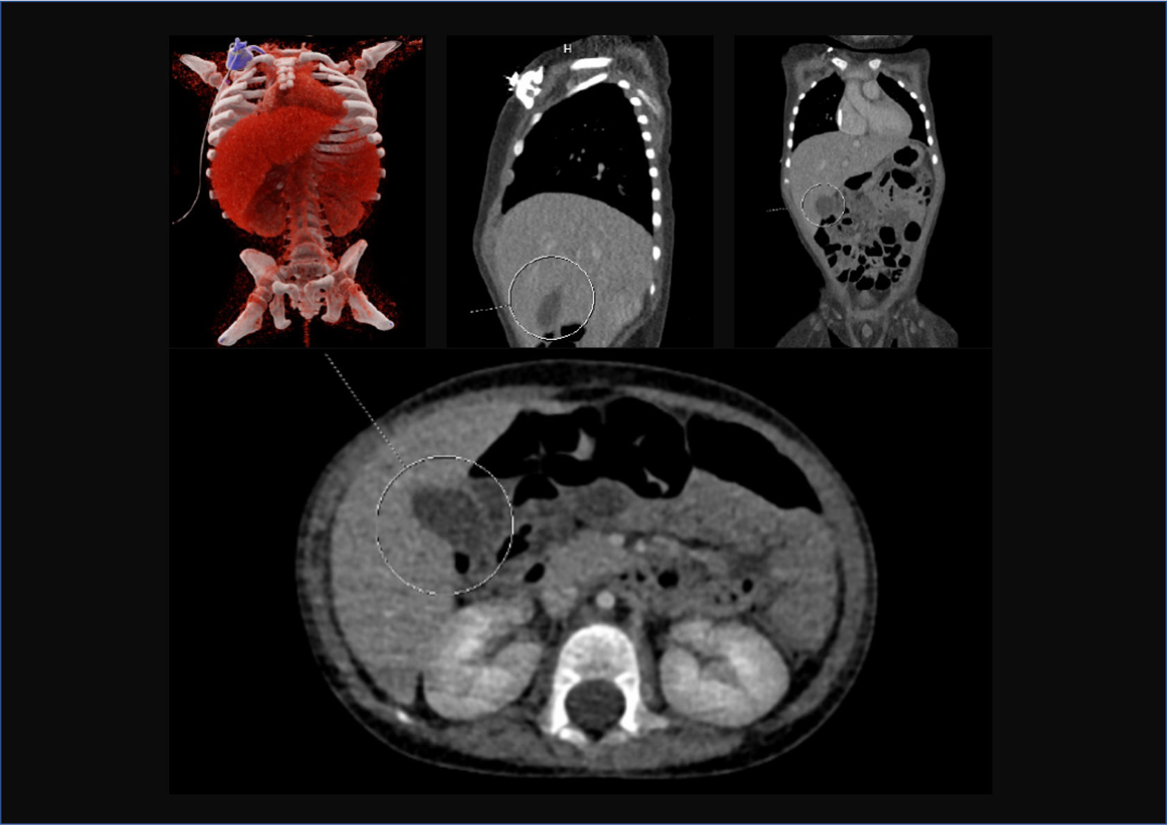 Ultra-Low Dose Free Breathing Pediatric CT Imaging