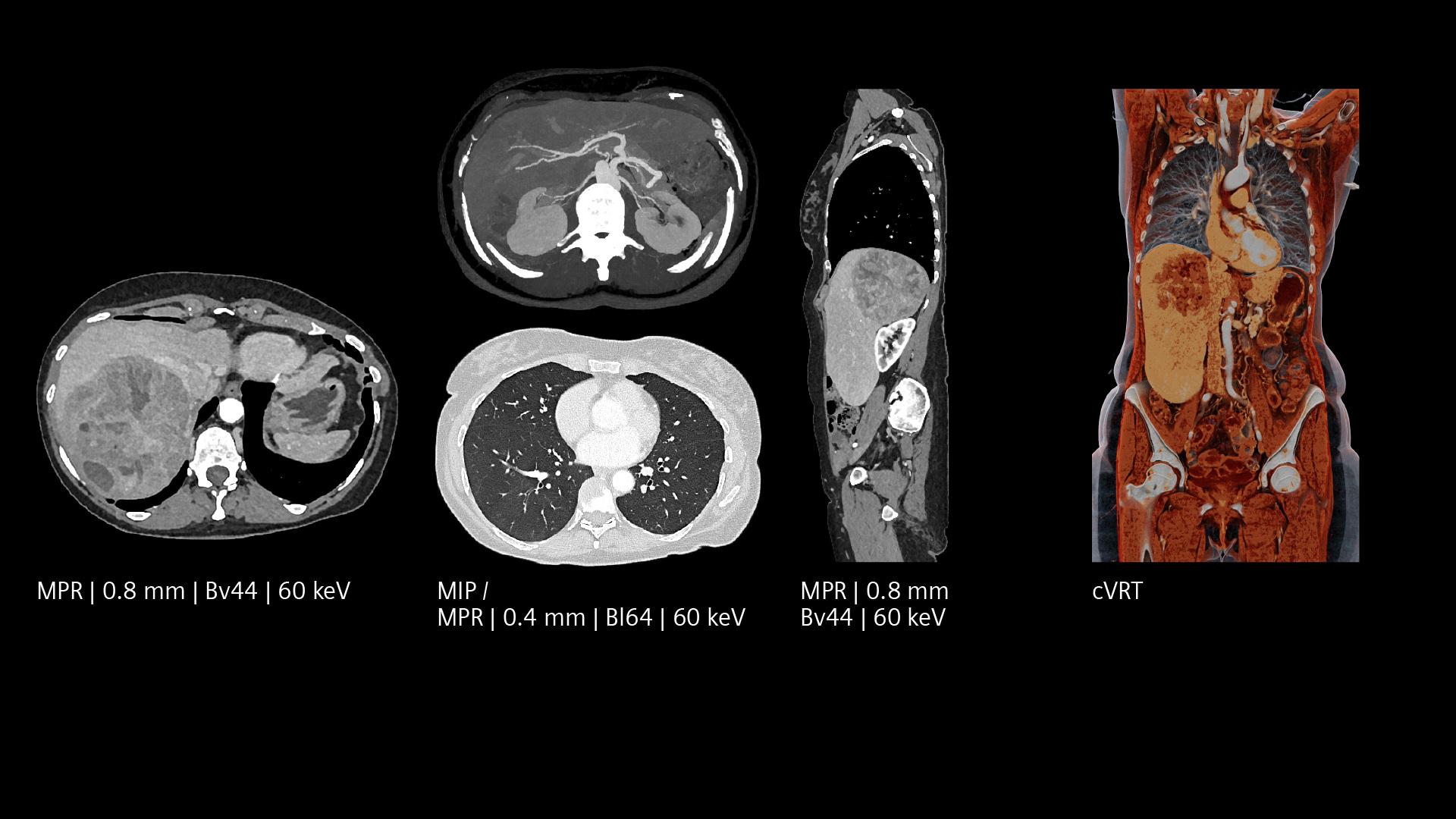 PCCT oncology imaging - Siemens Healthineers USA
