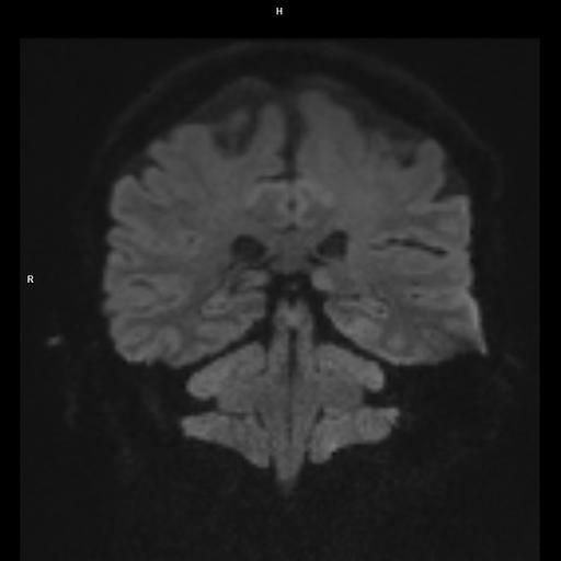 Coronal RESOLVE DWI_b-1000-MAGNETOM Vida - Siemens Healthineers USA