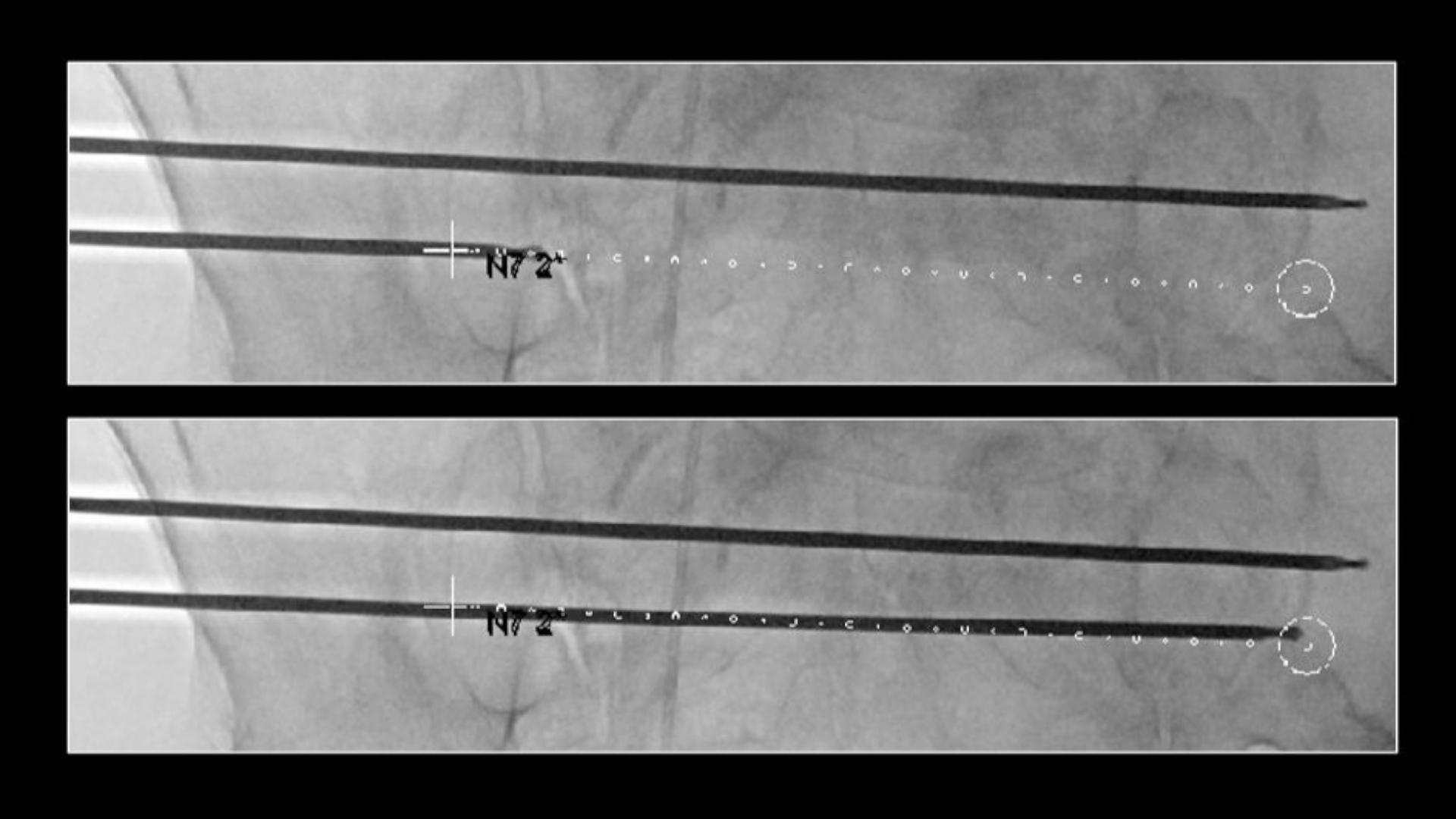 Interventional Oncology Procedures - Siemens Healthineers Vietnam