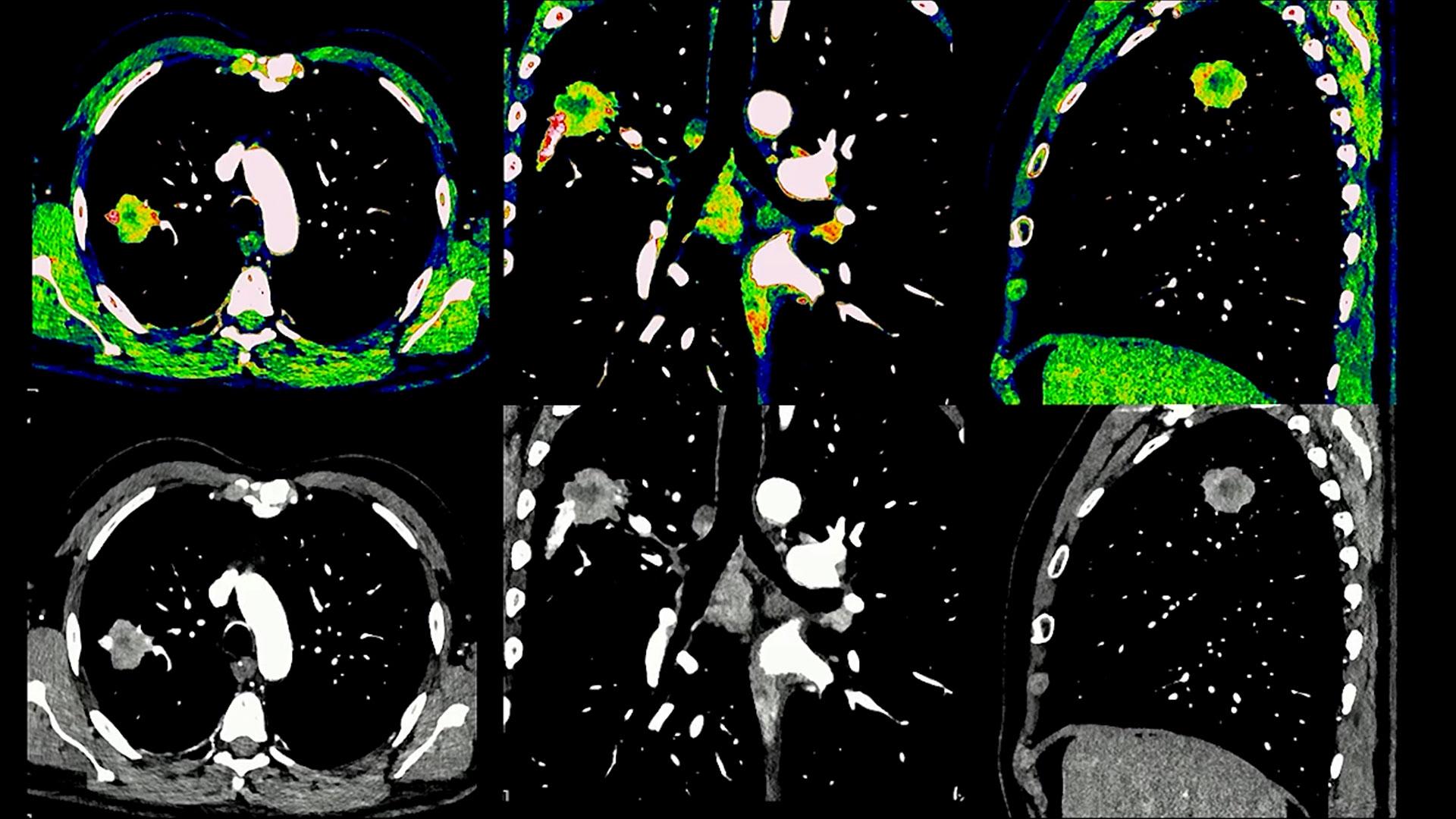 Imaging In Oncology With Photon Counting Ct