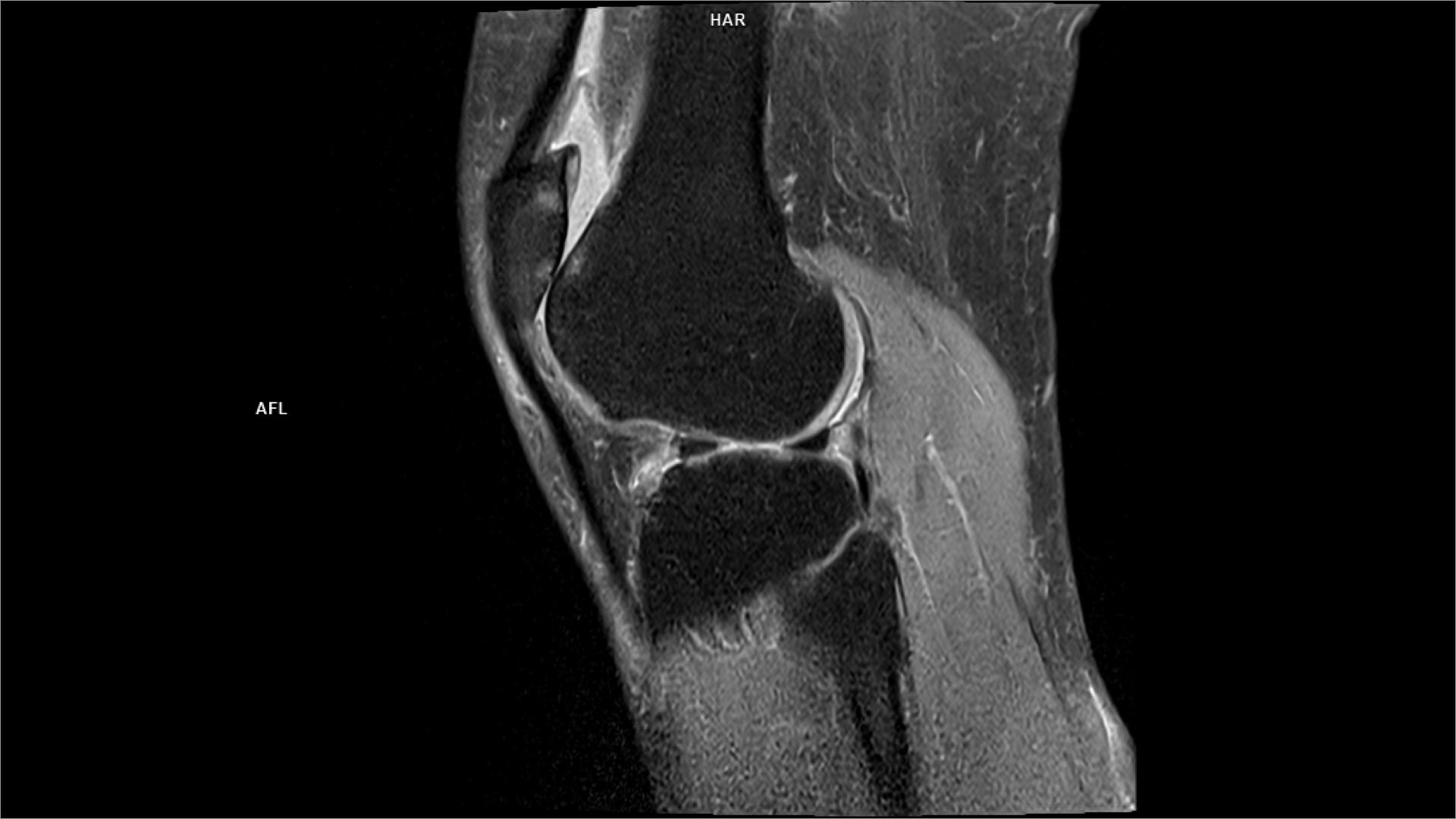 Sagittal PD FS-MAGNETOM Free.Max - Siemens Healthineers USA