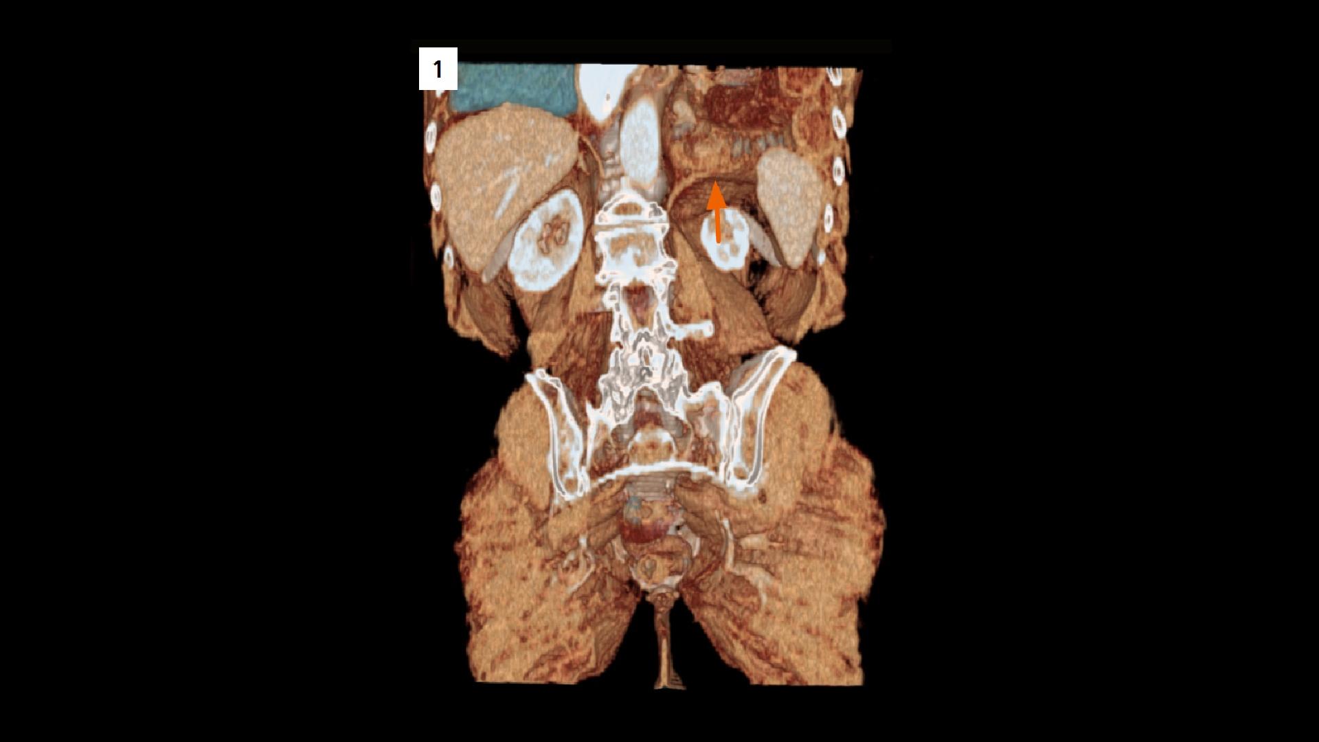 Small bowel infarction secondary to an acquired diaphragmatic hernia ...